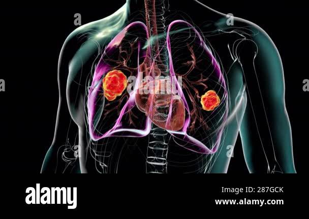 Lung mucormycosis, 3D animation showing fungal infection caused by ...