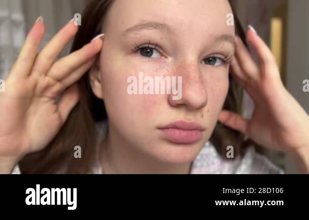 Close-up of teenage girl showing her skin swelling freckles problem ...