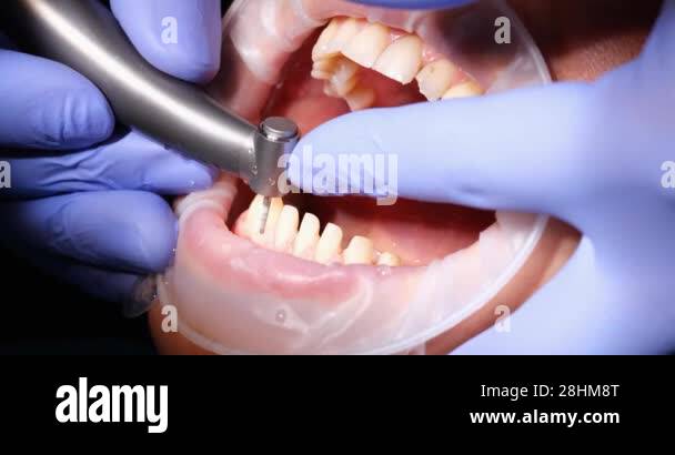 A closeup and detailed view of a dental procedure, showcasing teeth ...