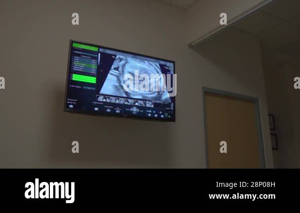 Ultrasound machine screen displaying a baby in the late stages of ...
