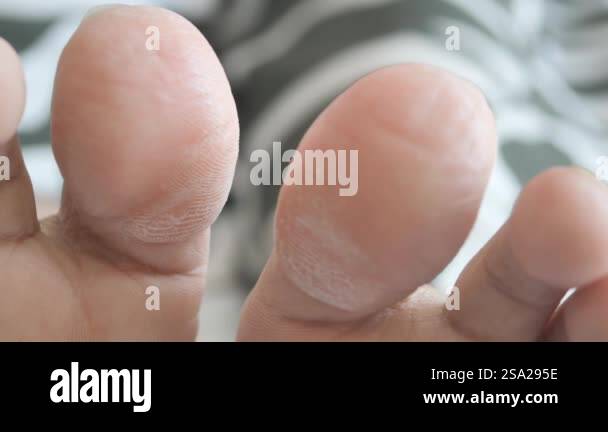 Detailed image showing dry, peeling skin on a human hand, highlighting ...