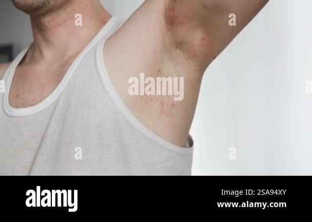 Armpit allergy. Young man shows and scratches irritation by hand on ...