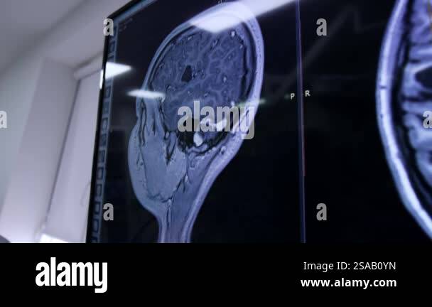 MRI scans of human head on the monitor. Close up. Equipment in surgery ...