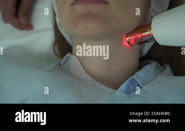 Rosacea treatment with IPL laser equipment in clinic 4k video. Removal ...