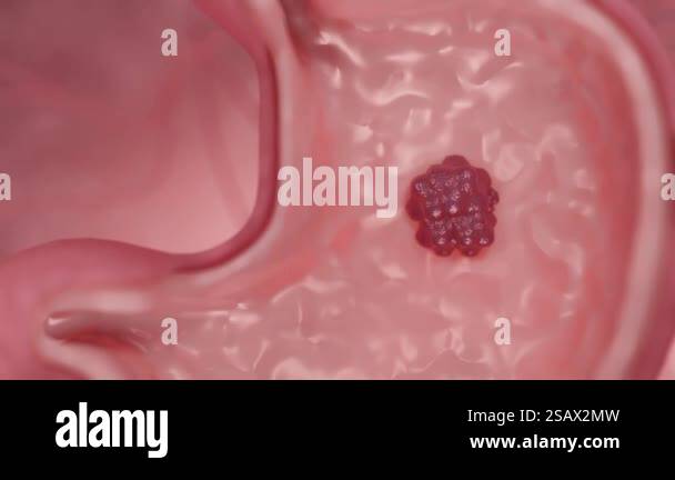 Gastric camera Stock Videos & Footage - HD and 4K Video Clips - Alamy
