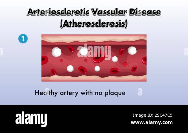 Animation depicting stages of atherosclerosis development Stock Video ...