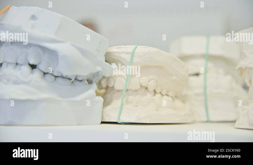 Dental gypsum model cast of human dental jaw. Laboratory prosthetics ...