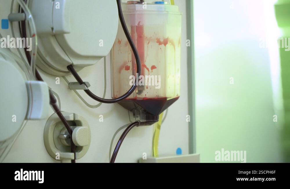 Plasmapheresis. Cleaning the patient s blood through the device. The ...