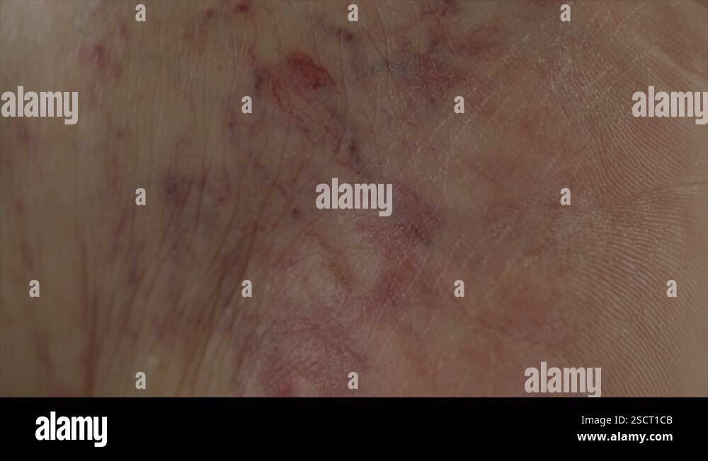 Veins on feet close up. Swollen old lady feet with burst blood vessels ...