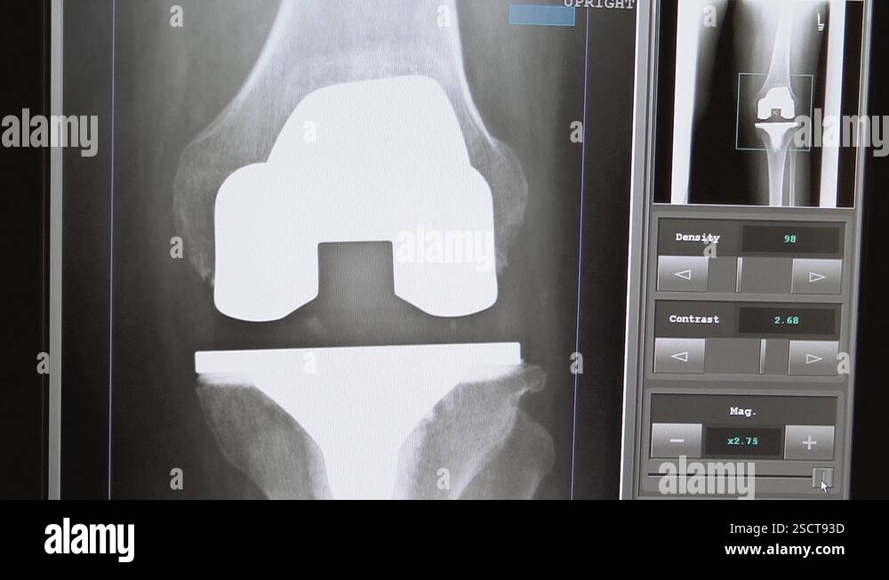 Xray of total knee replacement 2 views Stock Video Footage - Alamy