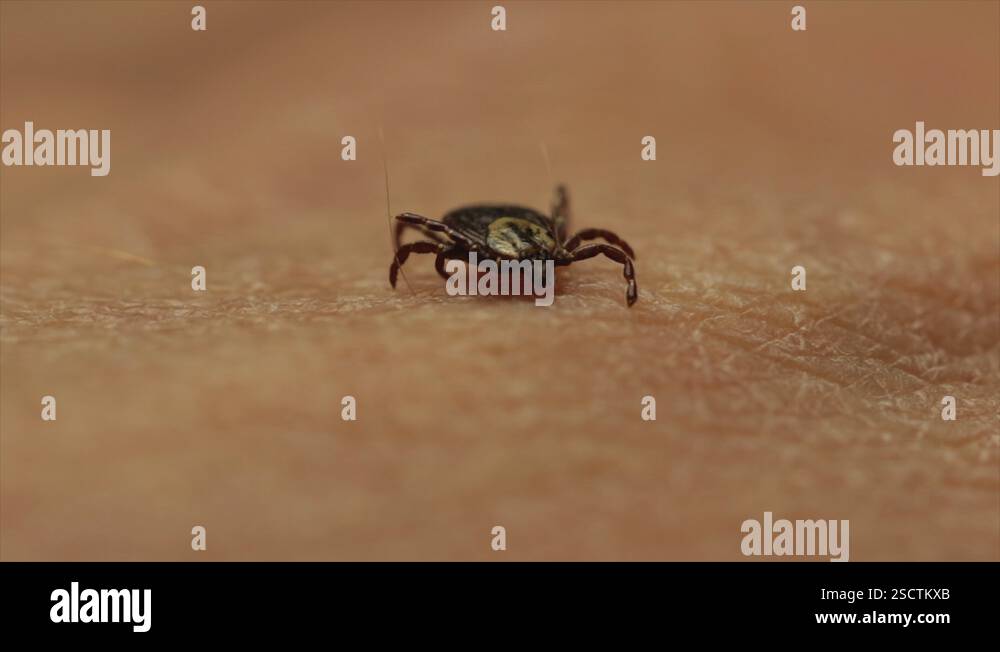 Lyme disease tick on human skin. Tick crawling on skin close up ...