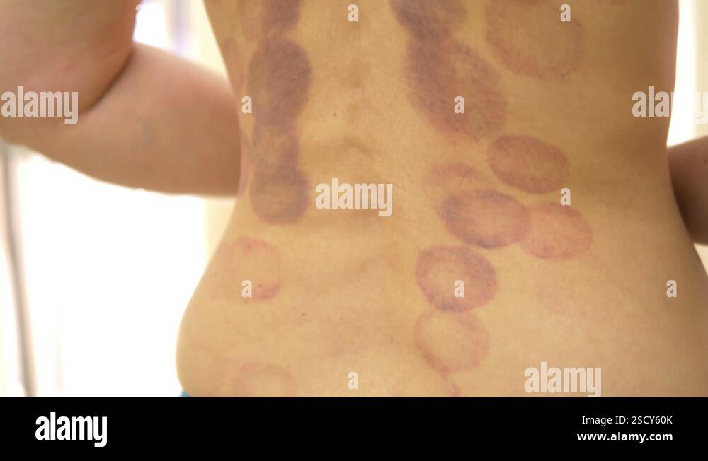 Round bruises. Traces on the back of a young woman after the procedure ...