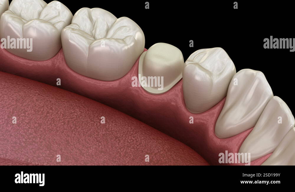 Preparated premolar tooth and dental metal-ceramic crown Stock Video ...