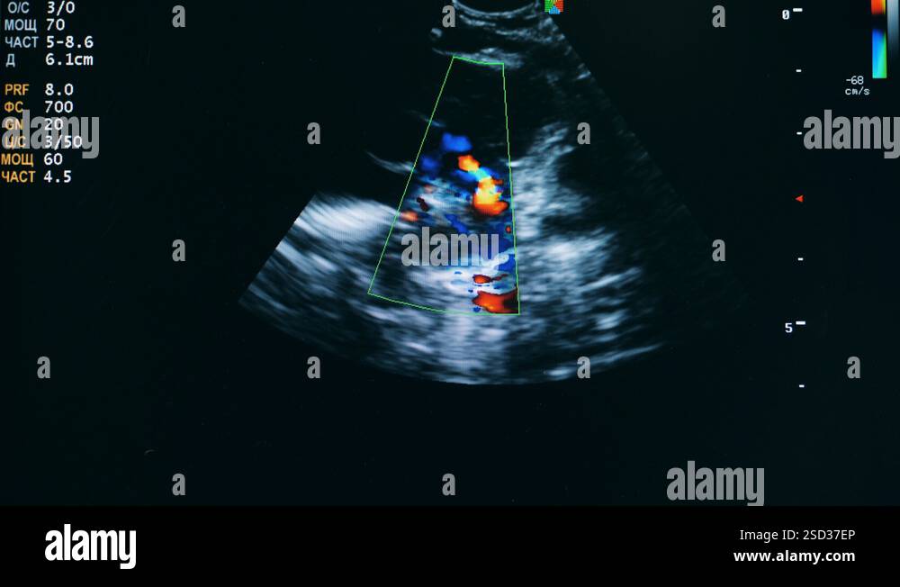 Ultrasound image on a computer screen Stock Video Footage - Alamy