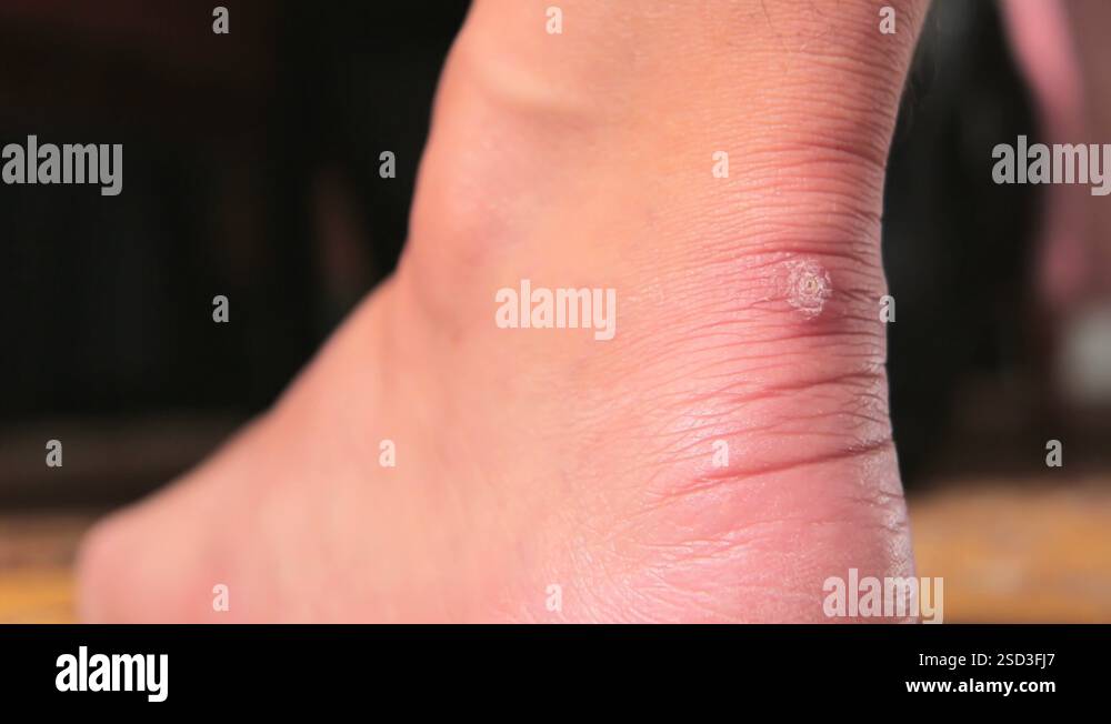 Putting bandage patch on the leg. Man putting medical patch on the ...