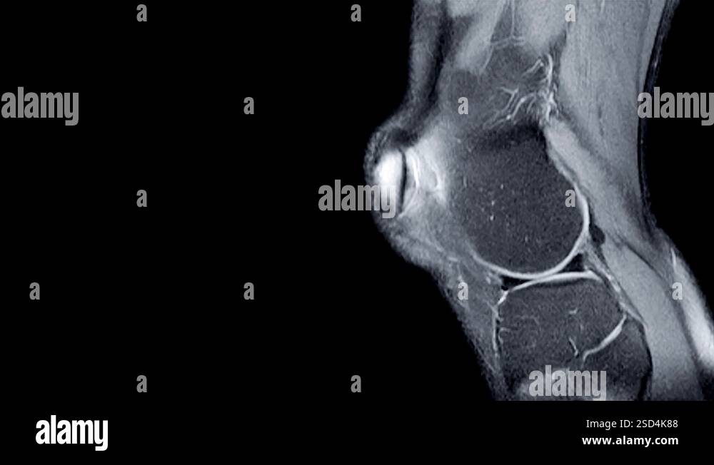 Magnetic resonance imaging (MRI) of right knee. Closed injury of the knee Stock Video Footage ...