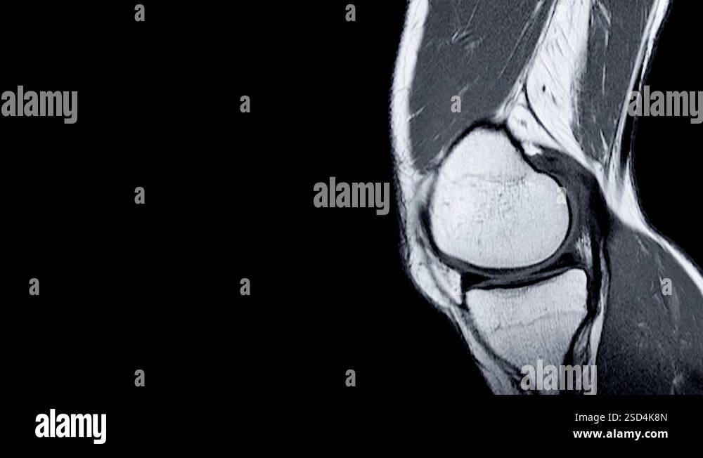 Magnetic resonance imaging (MRI) of right knee. Closed injury of the ...