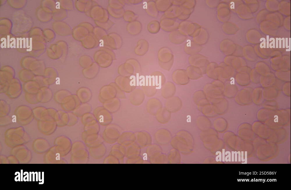 Human Blood. Blood Clots Under Microscope Stock Video Footage - Alamy