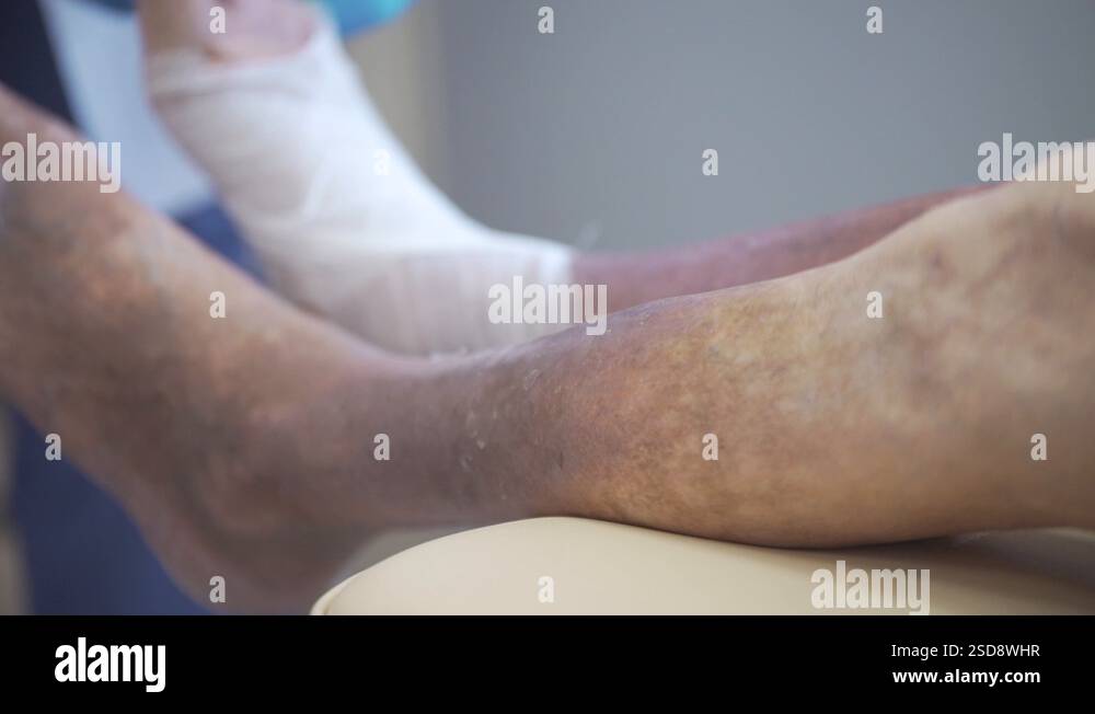 Varicose Veins, Sore Legs, blood Clot, Thrombophlebitis, trophic ulcers ...