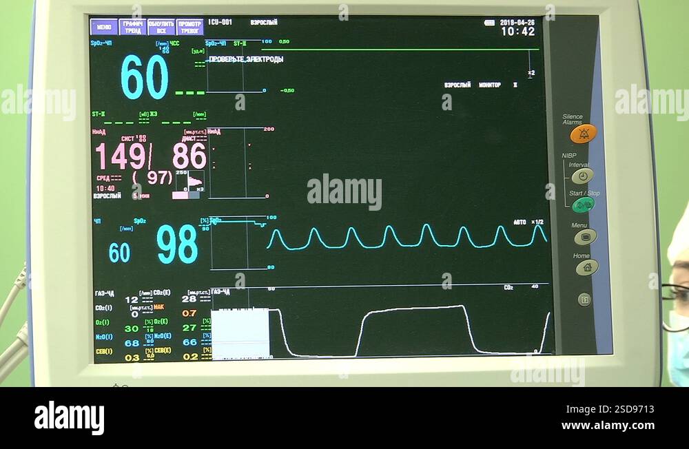 The work of a cardio monitor in the operating room Stock Video Footage ...