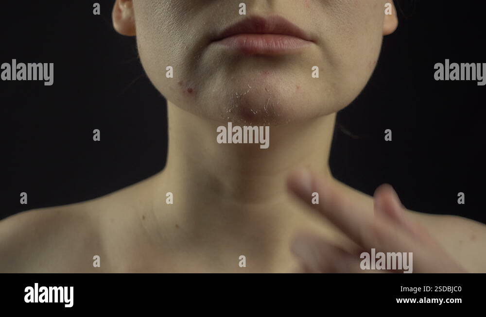 Close up of skin problems (unhealthy dry skin with acne and pimples ...