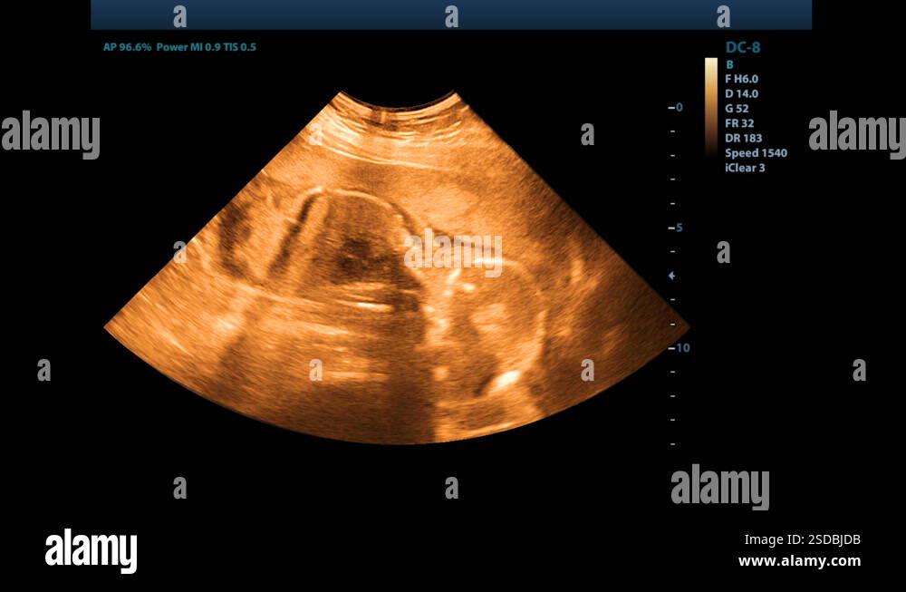 Ultrasound scanning of the human embryo. Ultrasound examination of the ...