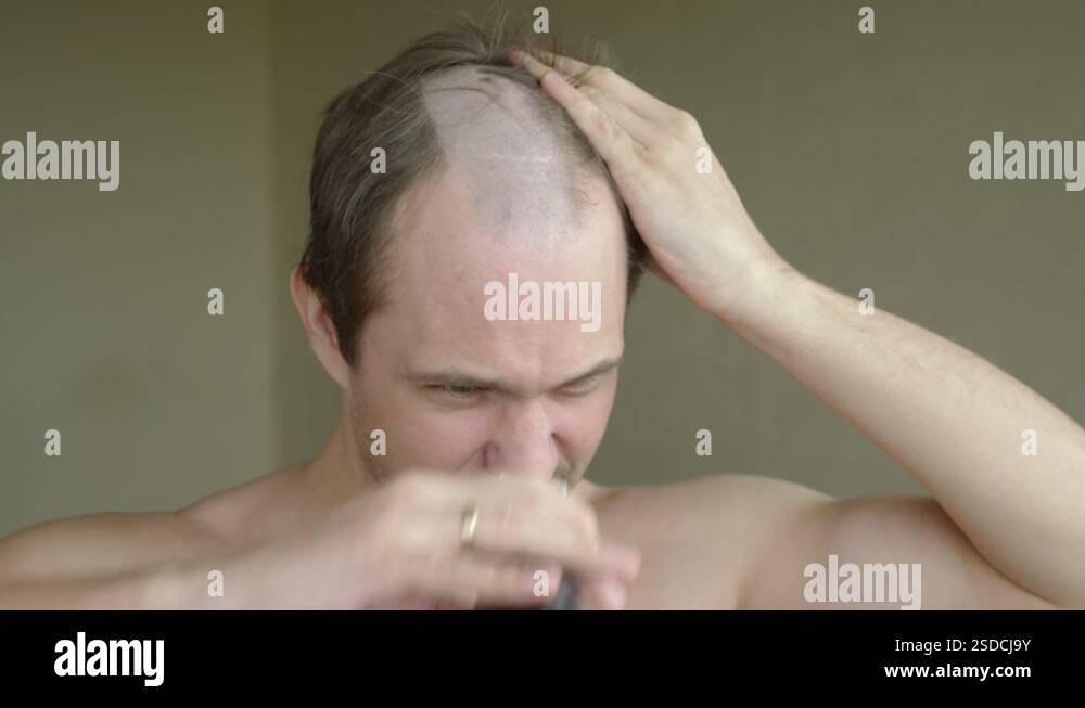 At home, a man shaves his bald spot in front of a mirror. hair loss ...