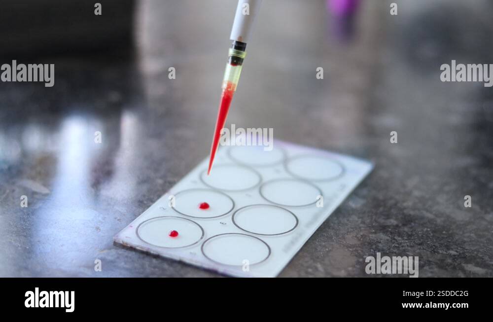 Close up of doctor hand Adding blood sample drops to glass panel using ...