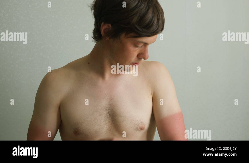 man touches reddened skin hands and winces in pain, sunburn without ...