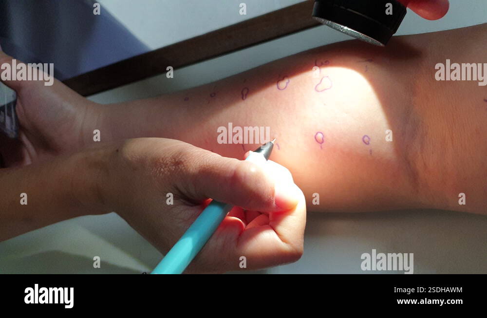 Medical skin prick test for allergy aerosol testing rash reaction Stock ...