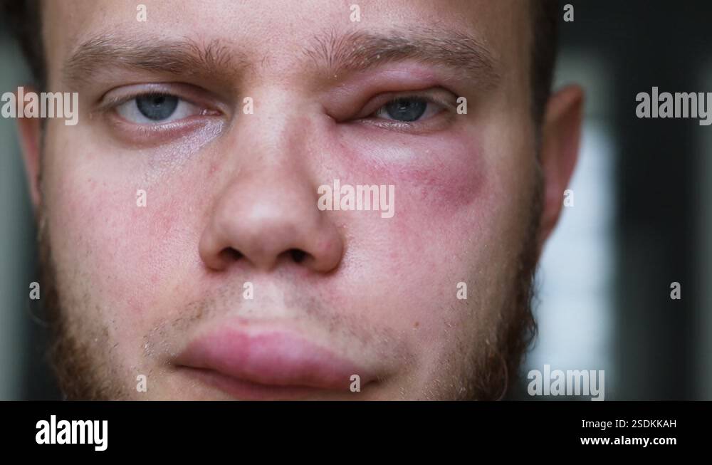 allergic reaction, edema of the face of men, angioedema ...