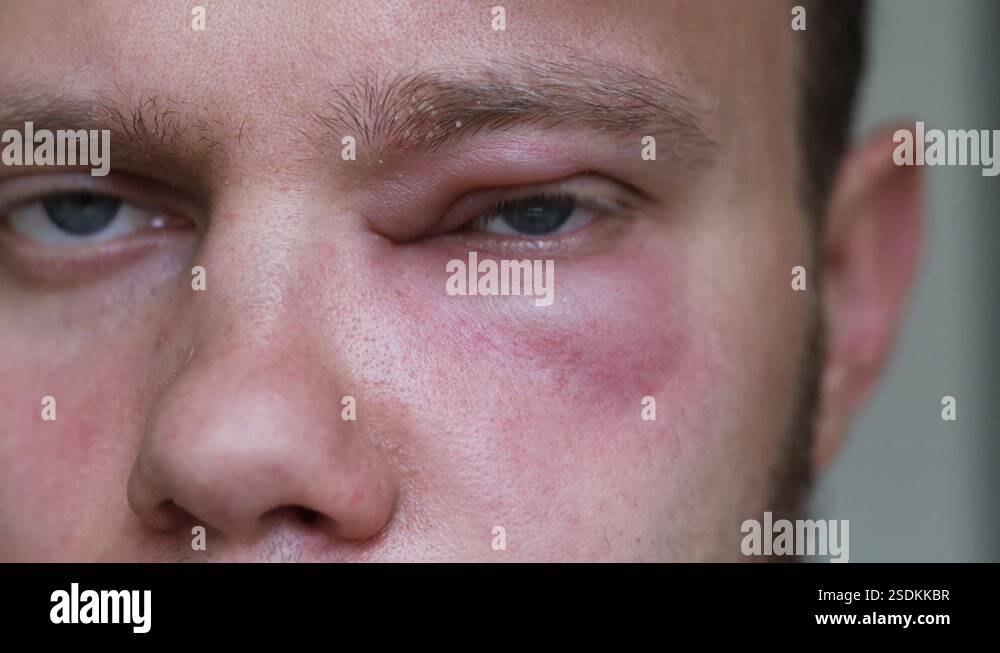 allergic reaction, edema of the face of men, angioedema ...