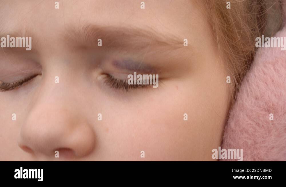 close up. A bruise on the little girl's left eye. bruised eyelid Stock ...