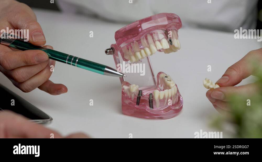 implantologist showing dental implant technology on tooth jaw model to ...
