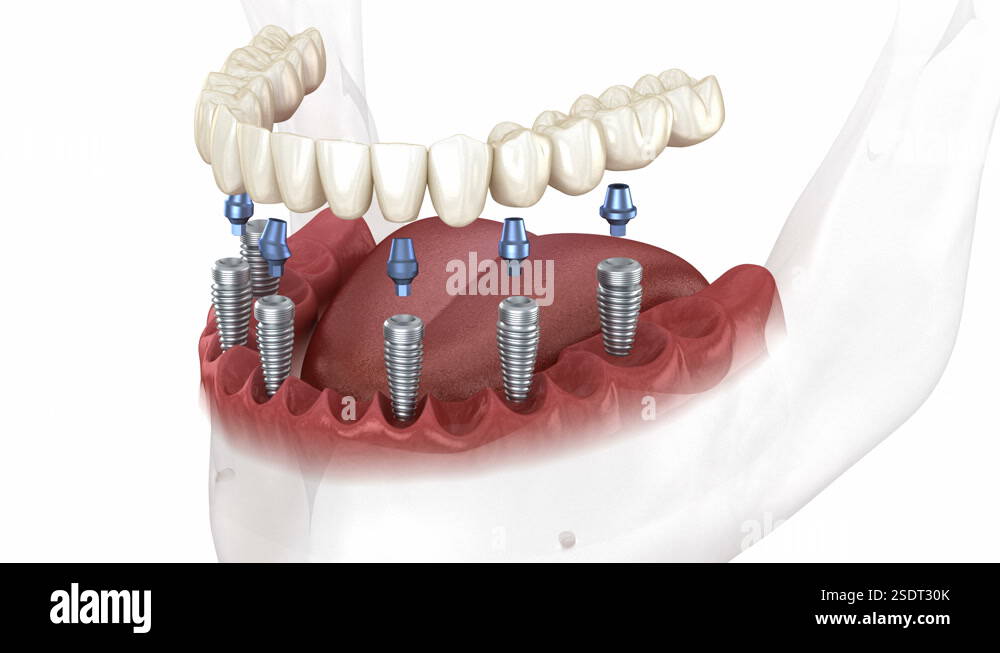 Removable mandibular prosthesis all on 6 system supported by implants ...