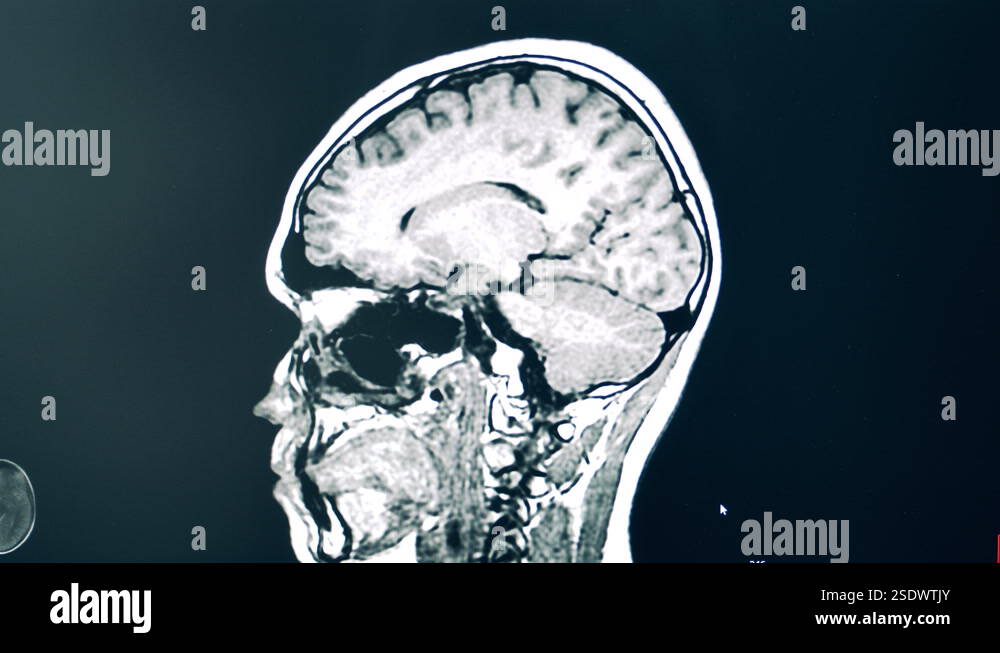 Brain scanning during an MRI procedure Stock Video Footage - Alamy