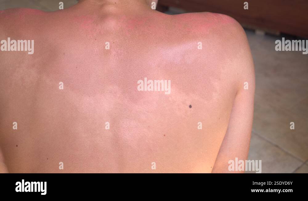 Solar burn on human skin. Symptoms and treatment. Sunburn blisters ...