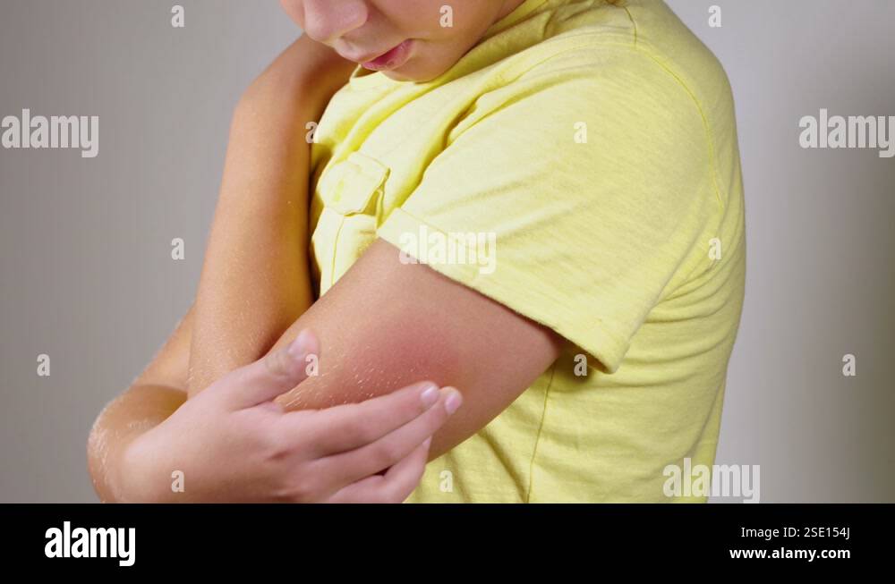 Kid looks at red spot on skin of arm caused by real allergy reaction to ...