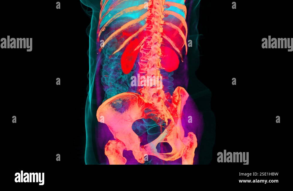 Computed tomography CT scan VR reconstruction of colonoscopy Stock ...