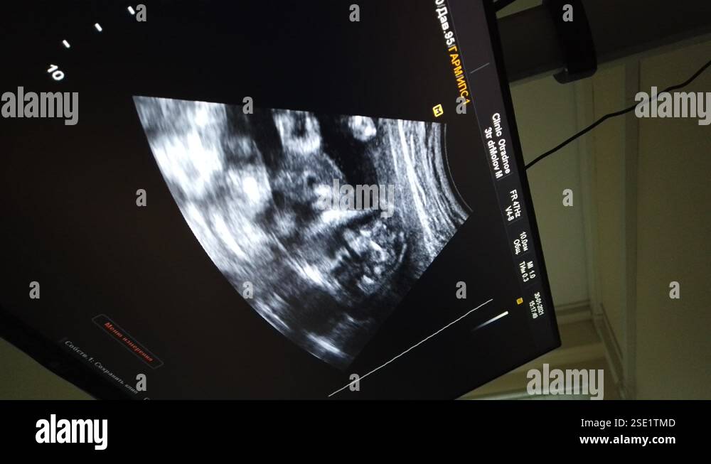 Medical ultrasound scanning, baby silhouette on the screen. Ultrasound ...