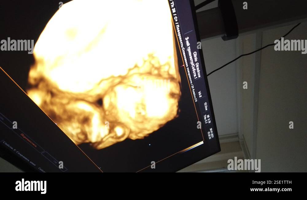 Medical ultrasound scanning, baby silhouette on the screen. Ultrasound ...