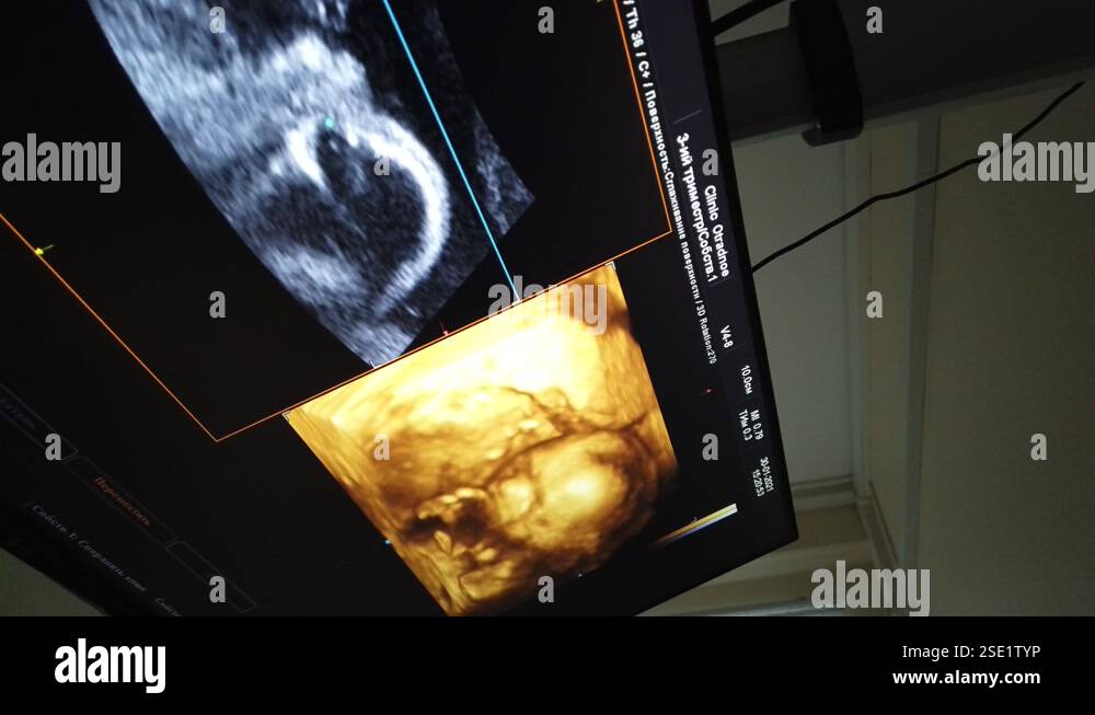 Medical ultrasound scanning, baby silhouette on the screen. Ultrasound ...
