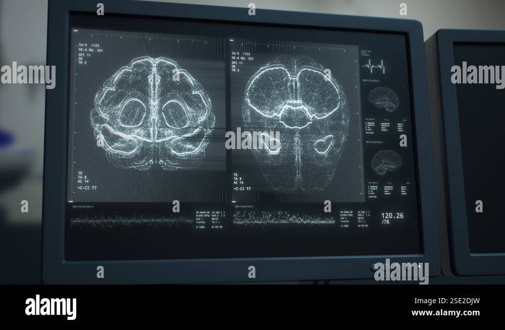 MRI brain scanning displayed on hospital screen, monitor Stock Video ...