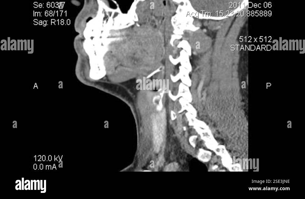 Sagittal plane tomography: CT scan layers of lower face and neck Stock ...