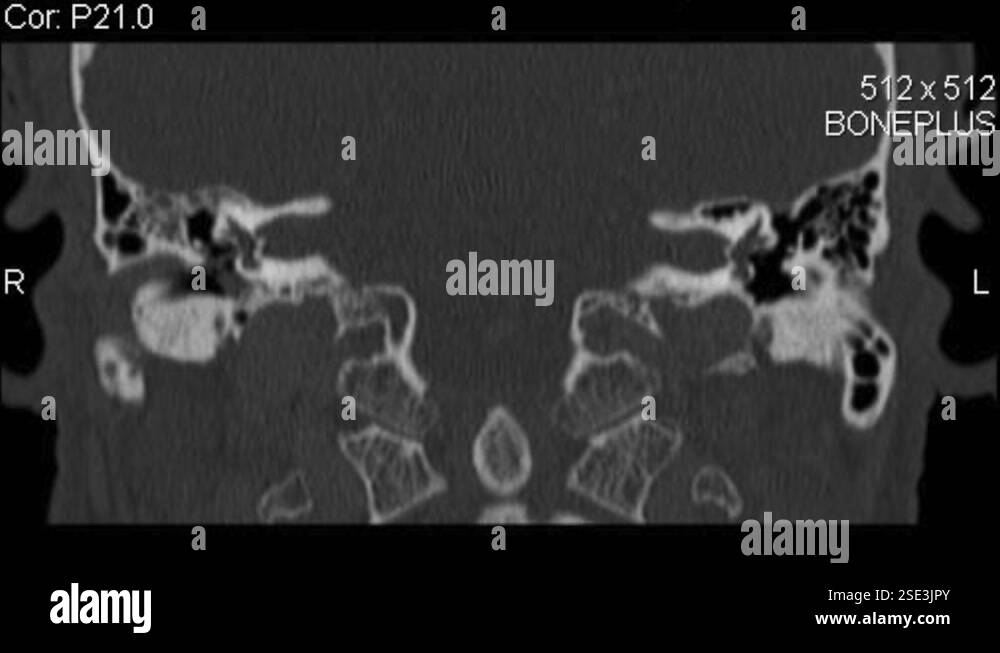 Coronal CT Computed Tomography scan layers of lower cranium and neck ...