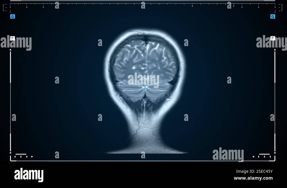 MRI scan of a human brain in motion. Scanning of brain magnetic resonance image Stock Video ...