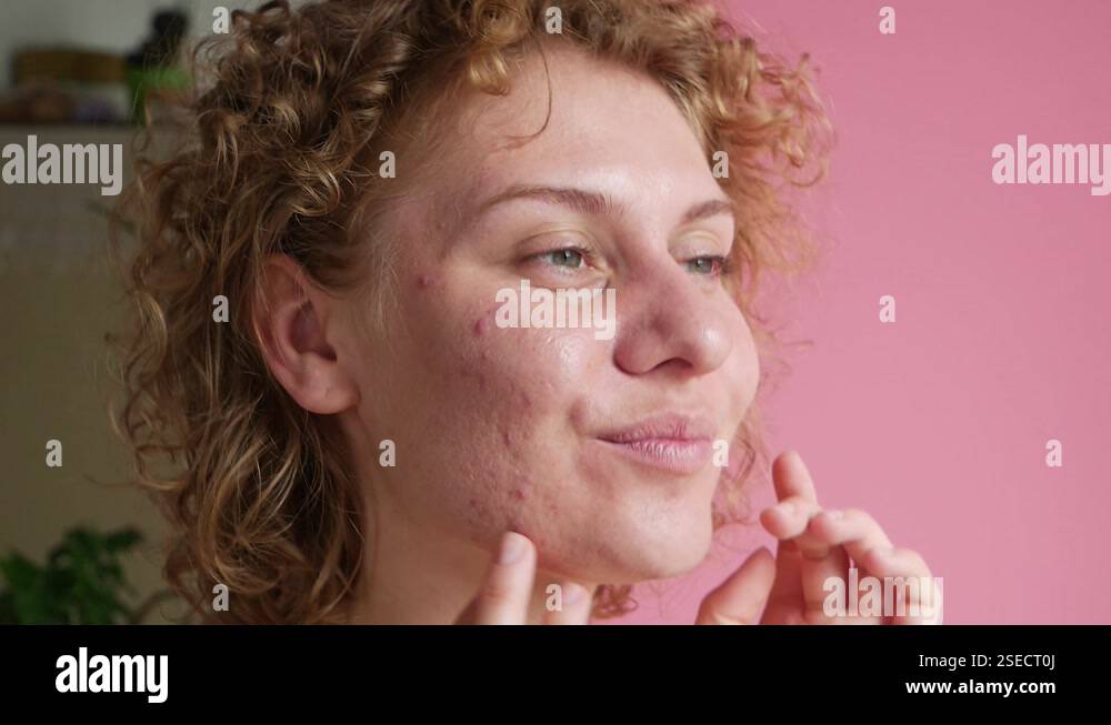 Woman with acne scar on her face is photographed with flowers Stock ...