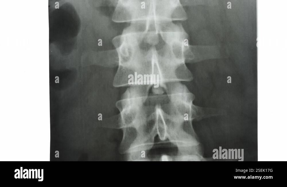 Camera movement along the spine X-ray. Vertical tracking of spinal ...