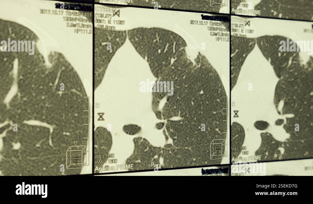 Magnetic resonance imaging (MRI) of the chest and lung Stock Video ...