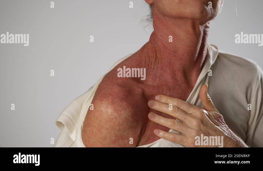 Closeup of woman showing skin rash hives on her shoulder. Shown on ...